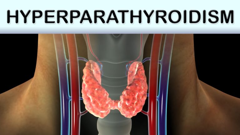 What You Need To Know About Hyperparathyroidism! | GetDoc Says