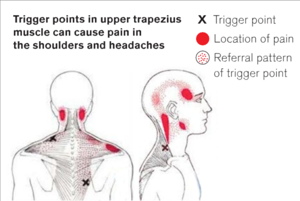 Aching Neck And Shoulders: Are they Muscle Knots?