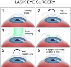Eye LASIK - How does it work? Is it Safe? and What to Expect?