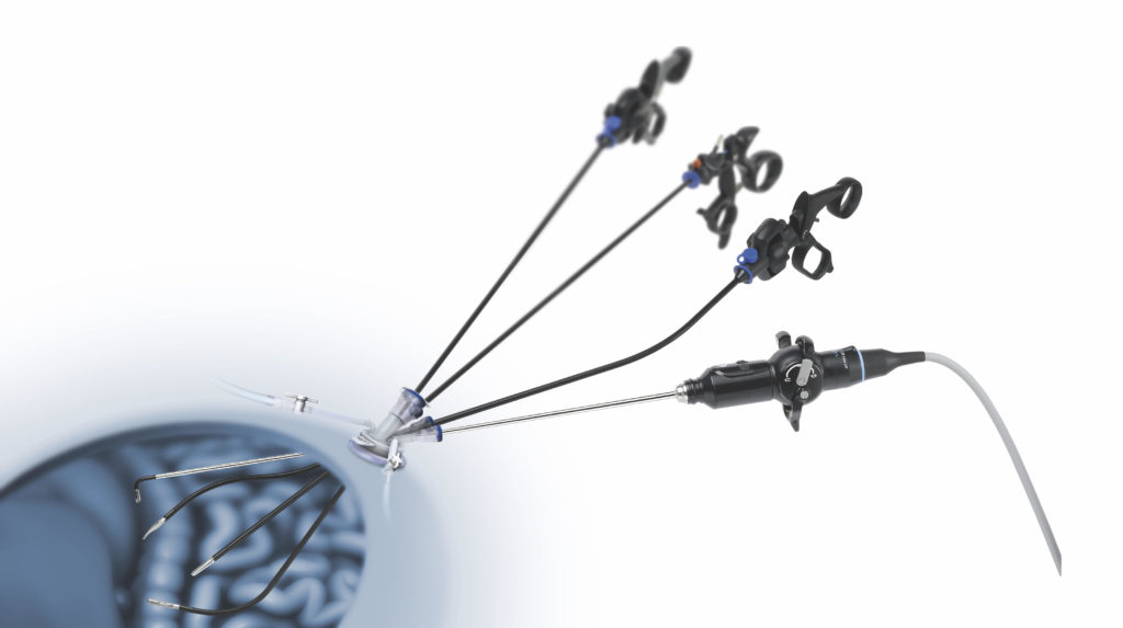 What is Single Incision Laparoscopy? | GetDoc