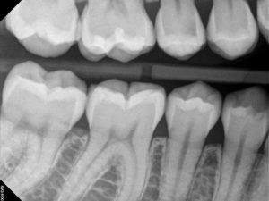 Oral Radiology - Common Types Of Intraoral Radiograph | GetDoc Says