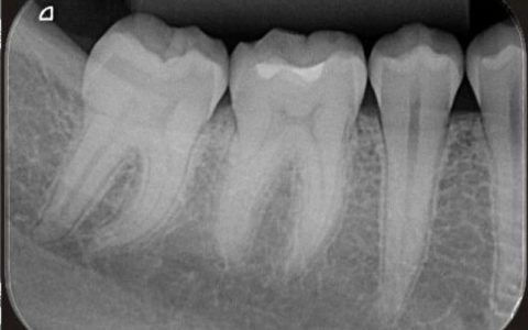 Oral Radiology - Common Types Of Intraoral Radiograph | GetDoc Says