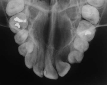 Oral Radiology - Common Types Of Intraoral Radiograph | GetDoc Says