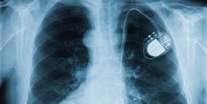 World's Smallest Cardiac Pacemaker Implanted by Farrer Park Hospital ...