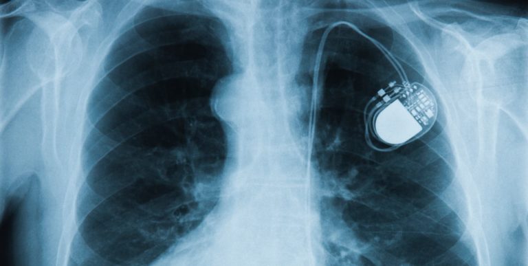 World's Smallest Cardiac Pacemaker Implanted by Farrer Park Hospital ...