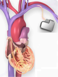 World's Smallest Cardiac Pacemaker Implanted by Farrer Park Hospital ...