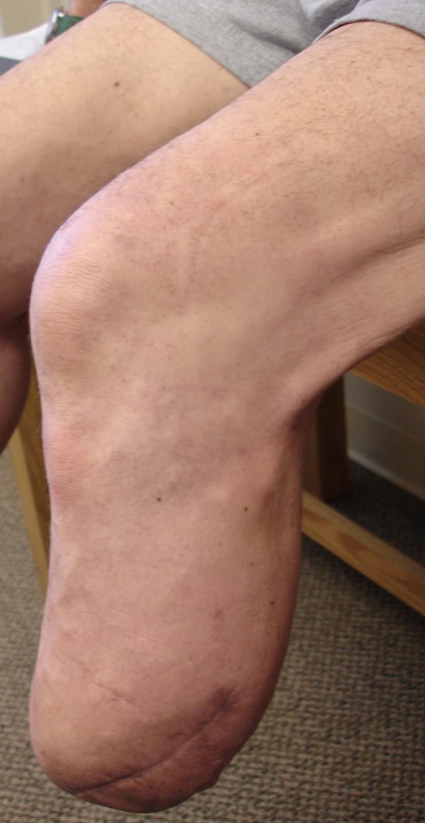 Diabetic Foot Ulcers (DFU) - Help for Diabetic Foot Ulcers