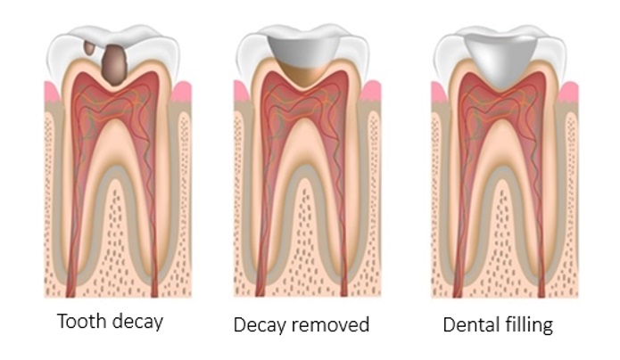 Tooth decay, dental caries, tooth cavities - Prevention tips