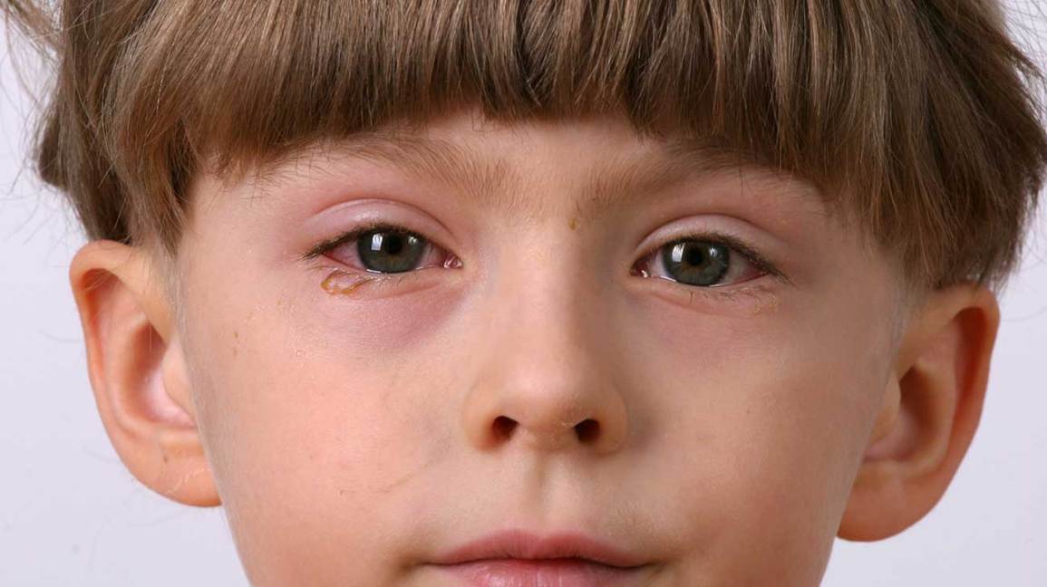 Pink Eye at First Sight? 6 Common Misconceptions About Conjunctivitis