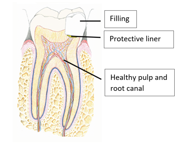 Vital Pulp Therapy: Saving Teeth One Pulp At A Time!