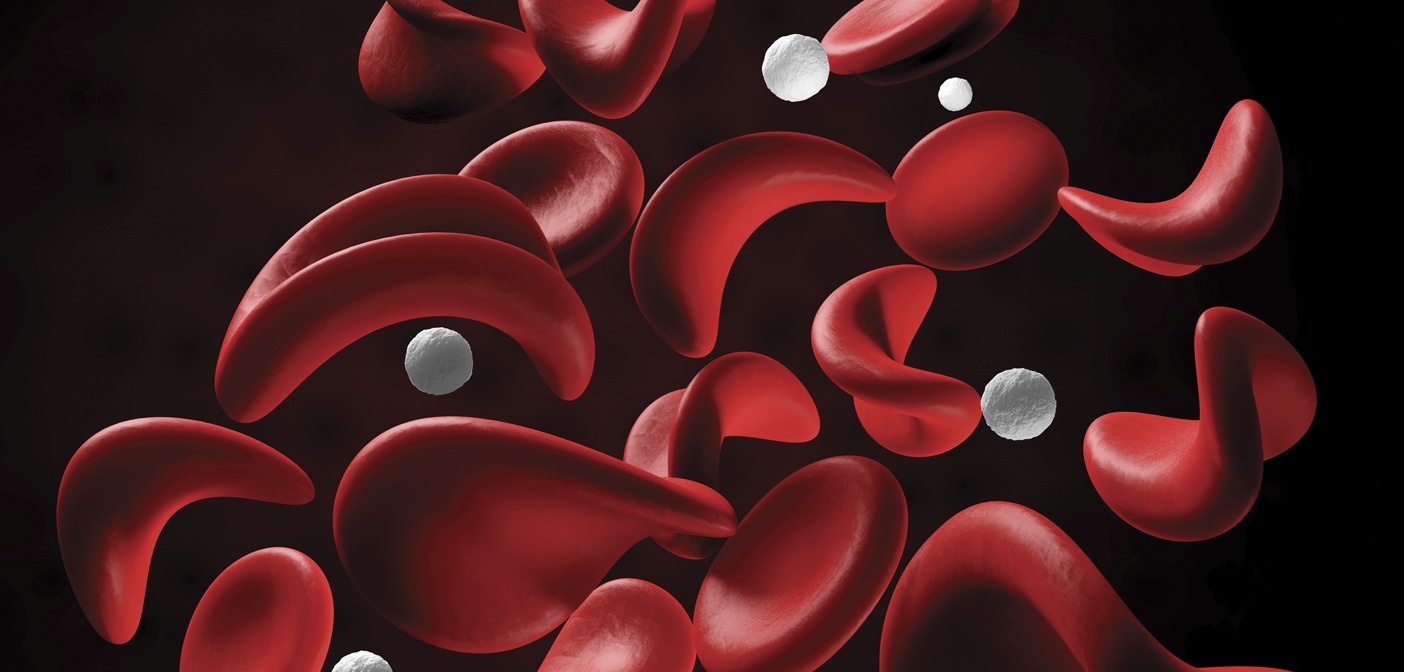 How One Child s Sickle Cell Mutation Saved The Lives Of Many