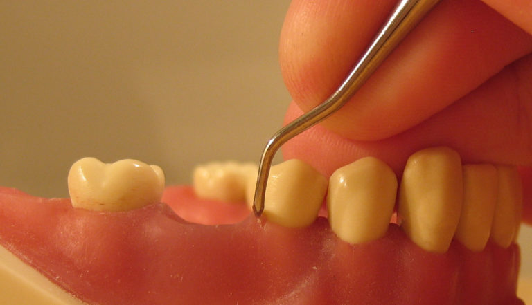 Dental Scale and Polish: What It Is and Why It Is Necessary