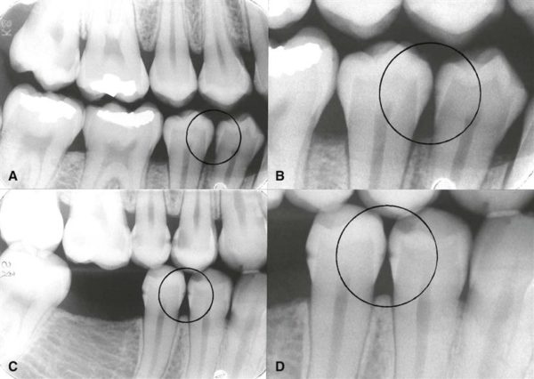 Dental X-Rays: How and Why We Need to See Beyond the Teeth