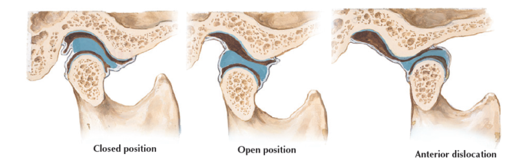 Temporomandibular Joint Disorder: Ow, My Jaw Hurts!