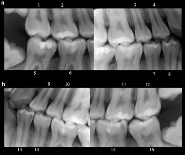 Dental X-Rays: How and Why We Need to See Beyond the Teeth