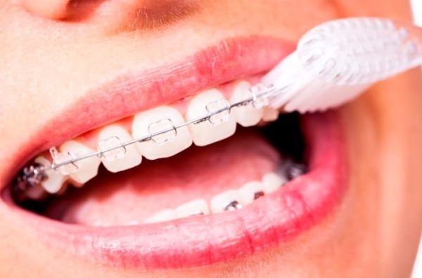 5 Simple Tips to Take Care of Your Teeth and Braces